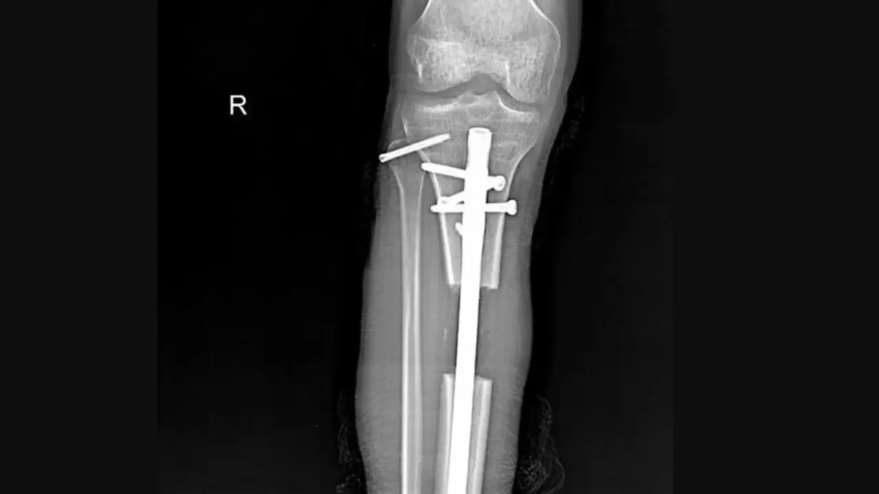 Pria Ini Lakukan Operasi Pemanjangan Kaki karena Diejek Pendek, Lihat ...