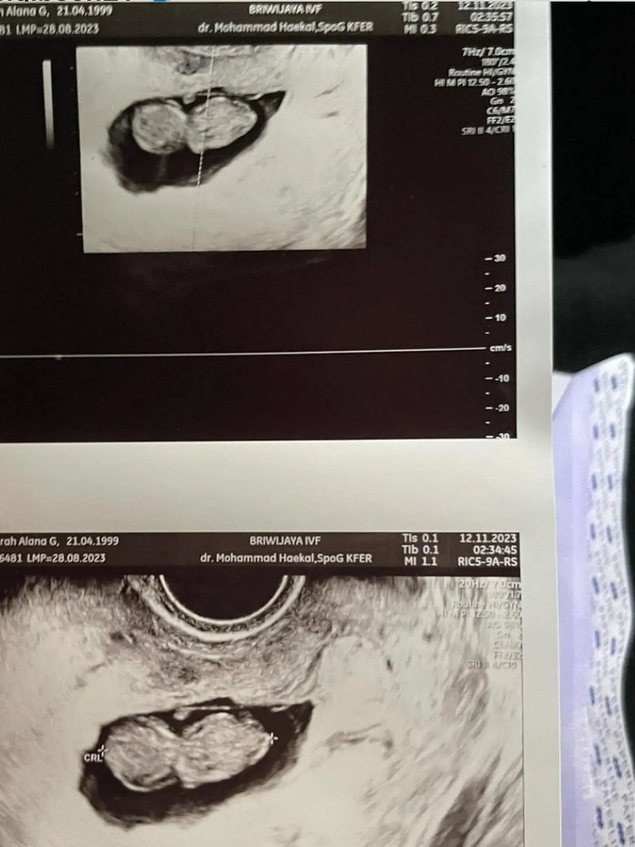 7 Potret Sarah Gibson Keguguran Janin Dua Kali, Sempat Dirahasiakan ...