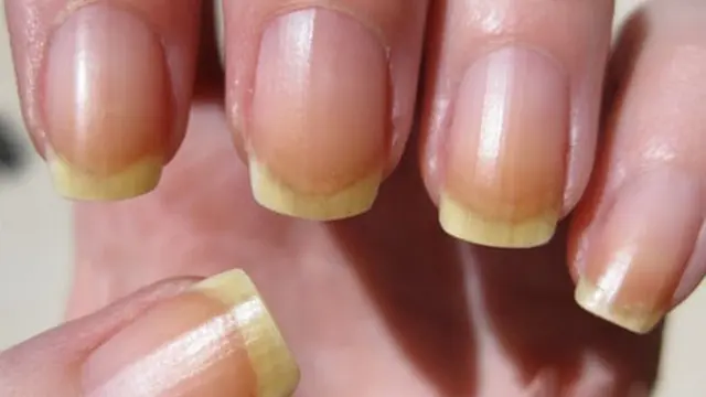 7 Penyebab Kuku Kuning dan Cara Mengatasinya yang Tepat - Hot Liputan6.com