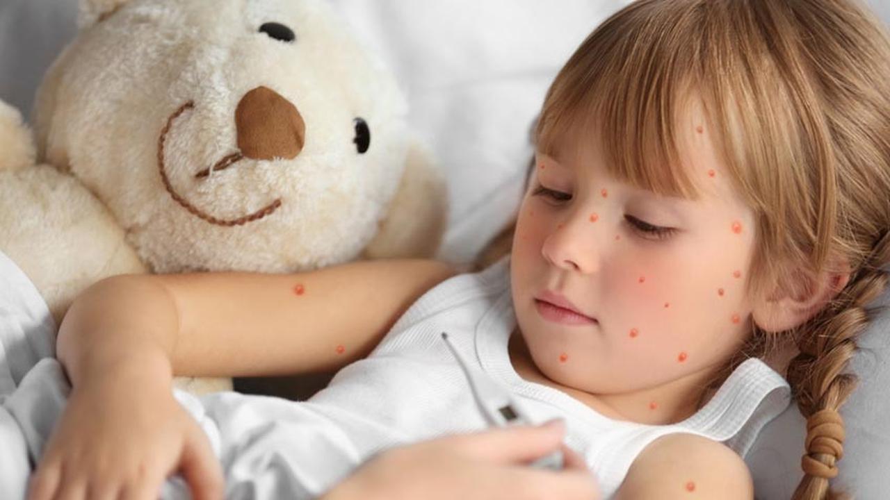 Morbili Adalah Penyakit Infeksi Menular, Kenali Gejala dan Penyebabnya