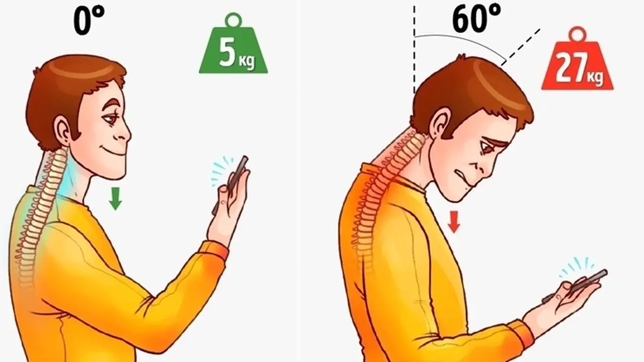 Kifosis Adalah Kondisi Postur Bungkuk, Berikut Gejala dan Penanganan ...