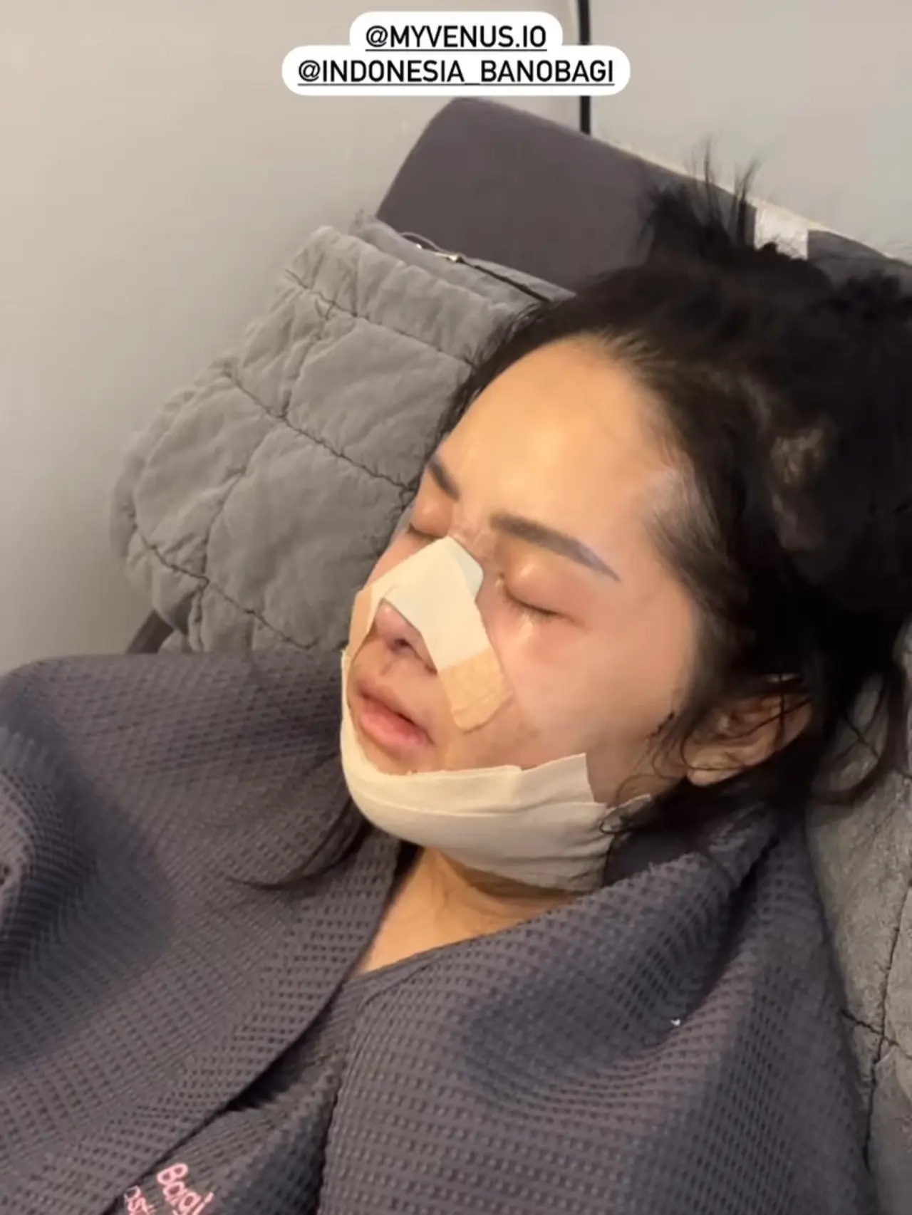 6 Potret Mawar AFI Oplas Hidung Kedua di Korea, Implan Pakai Tulang Iga ...