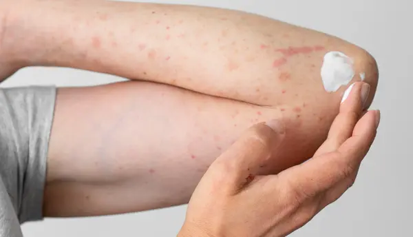 Mengenal Ciri-ciri Penyakit TBC: Gejala, Penyebab, dan Penanganannya - Feeds Liputan6.com