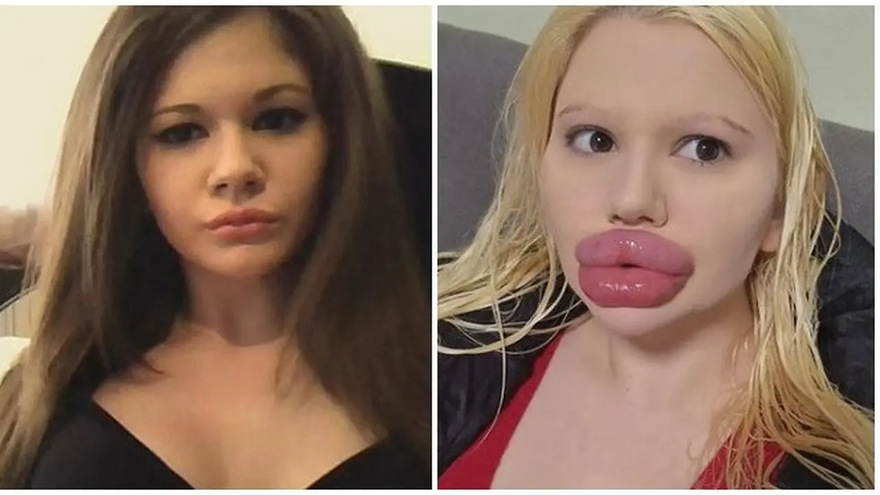 6 Foto Terkini Andrea Ivanova Wanita Viral Pemilik Bibir Terbesar, Kini ...