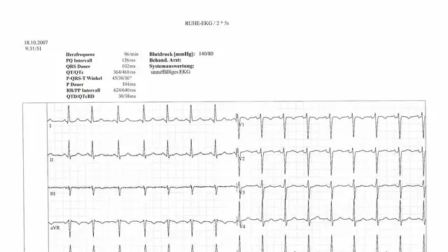 9 Cara Membaca EKG untuk Pemeriksaan Jantung, Pahami Tahapannya - Hot ...