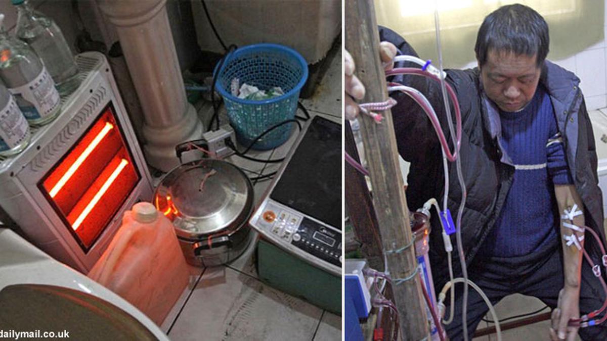 Pria Ini Pakai Alat Sederhana Buatan Sendiri untuk Cuci Darah - Health ...