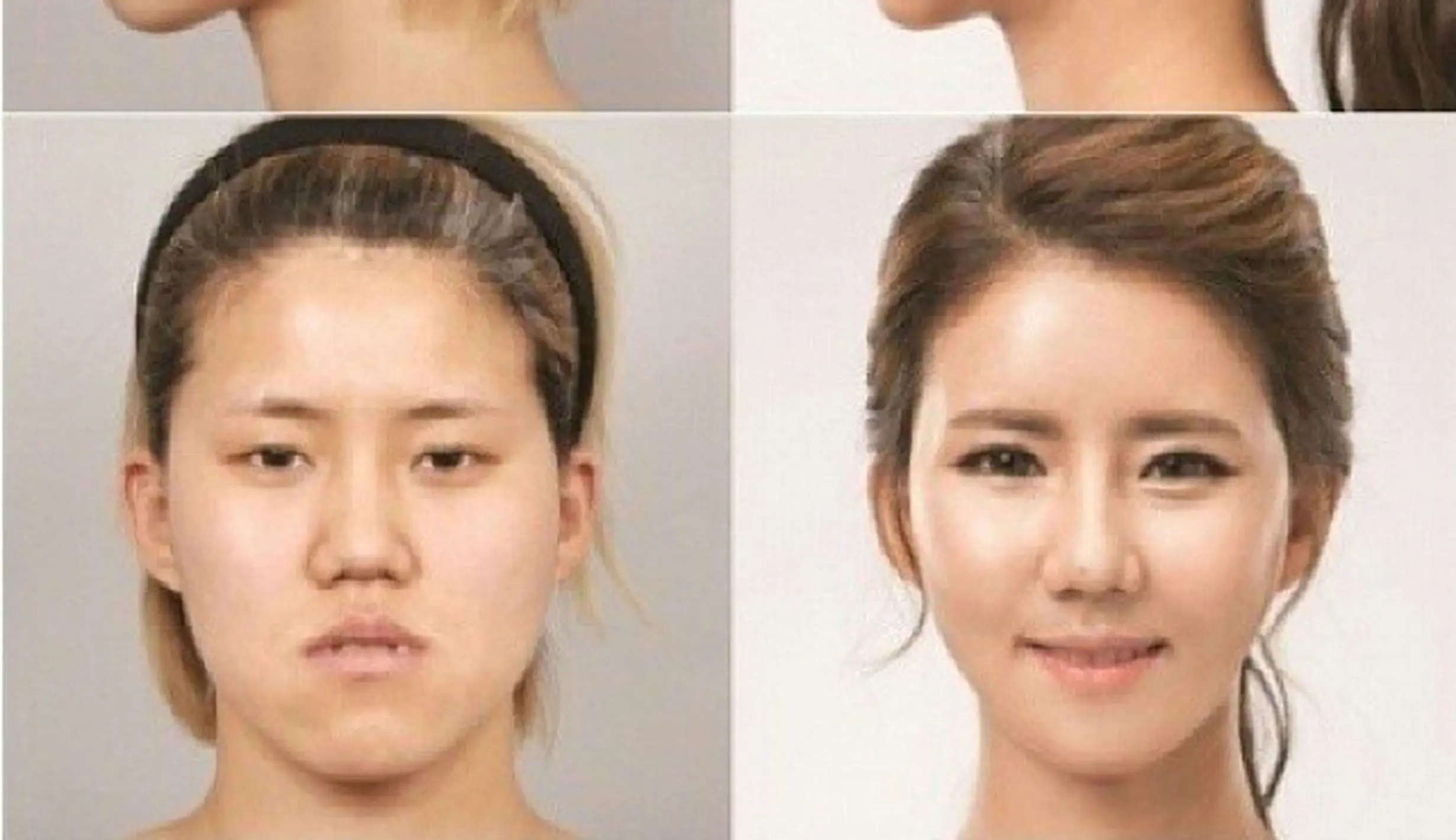 Before After Operasi Plastik Karya ID Hospital Korea Selatan - Photo ...