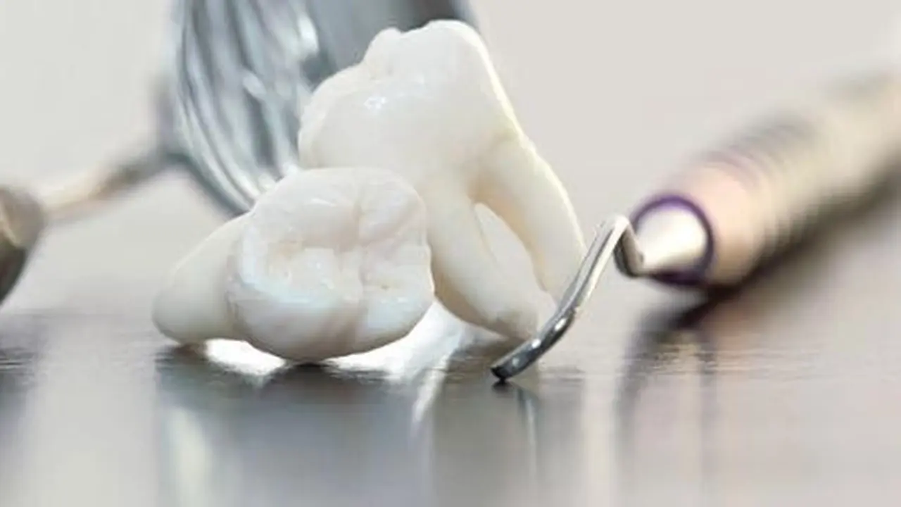 Hukum Cabut Gigi saat Puasa Ramadan, Batal atau Tidak? Ini Fatwa MUI ...