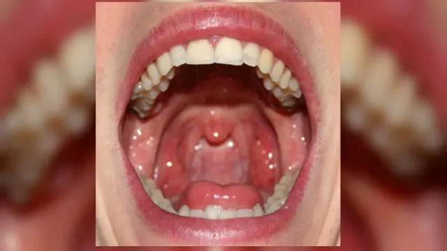 Tahukah Anda? Ini 10 Fakta Menjijikan tentang Mulut Manusia - Global ...