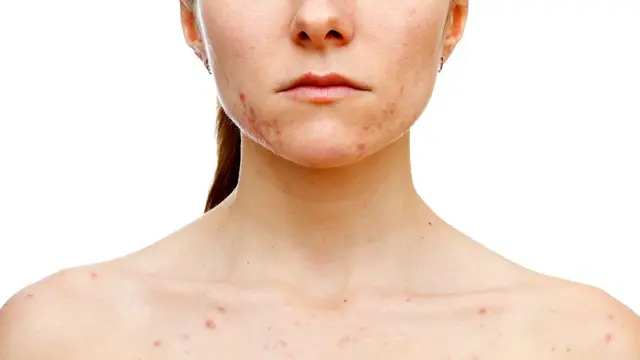 Mengenal Lebih Jauh 3 Jenis Bisul dan Cara Mengobatinya - Health ...