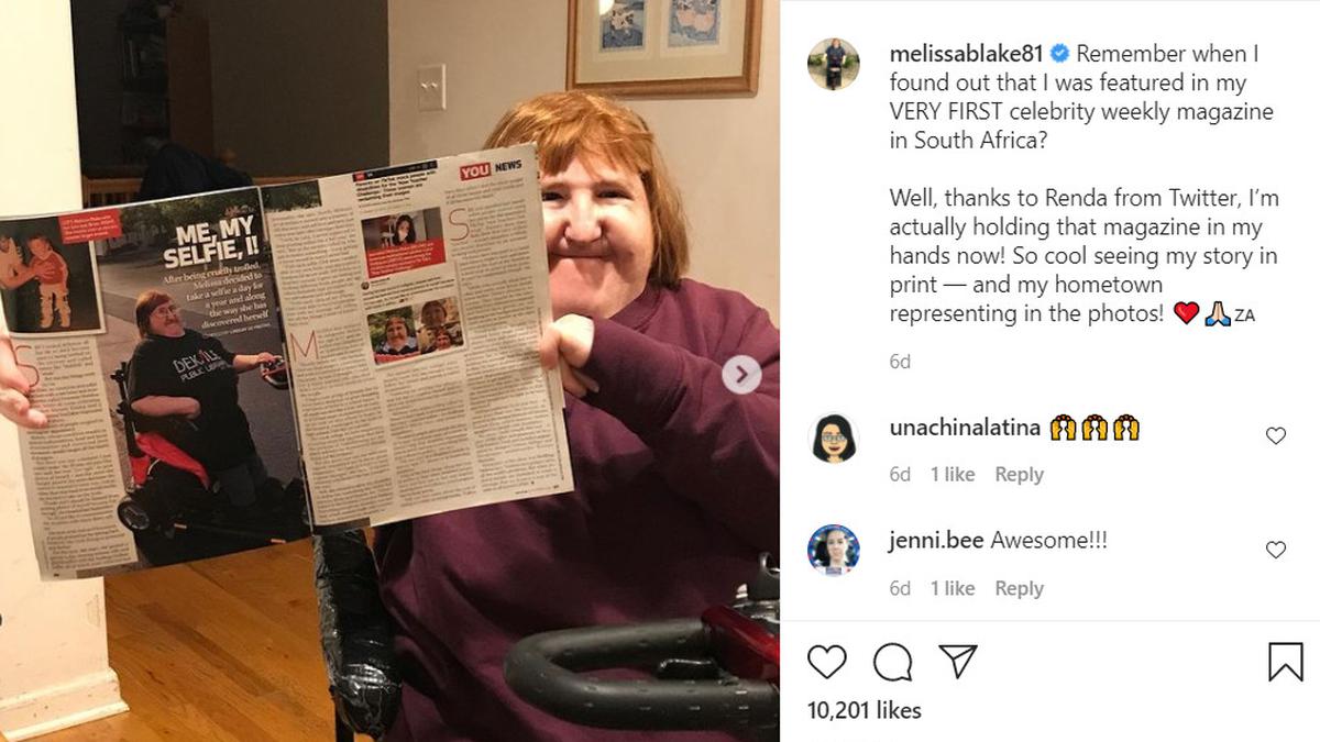 Melissa Blake, Wanita dengan Disabilitas Langka Bakal Jadi Model New ...