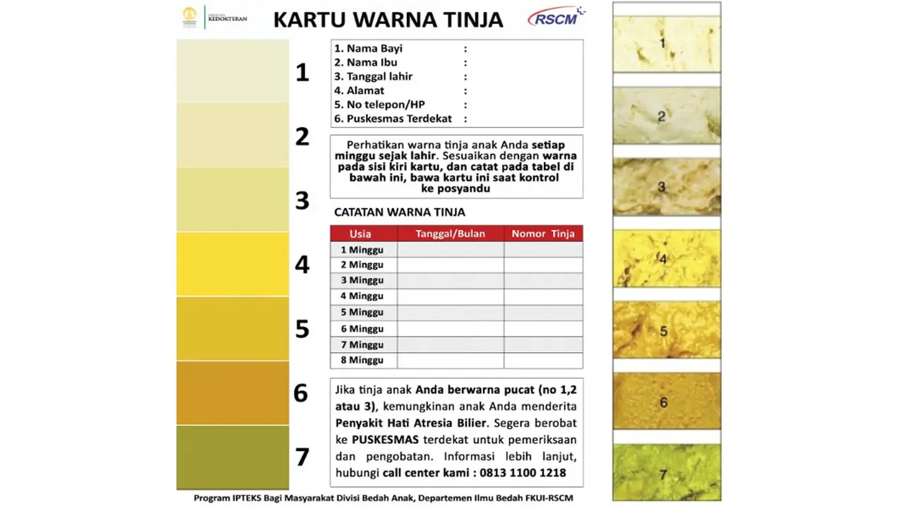 Jangan Diabaikan, Kenali Gejala Kuning yang Tidak Normal pada Bayi Baru Lahir - Health Liputan6.com
