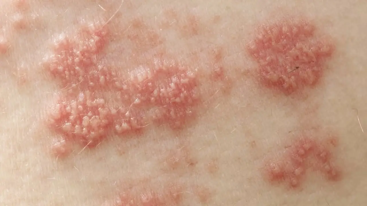 17 Jenis Gatal pada Kulit dan Gambarnya, Umum Diderita Semua Usia - Hot ...