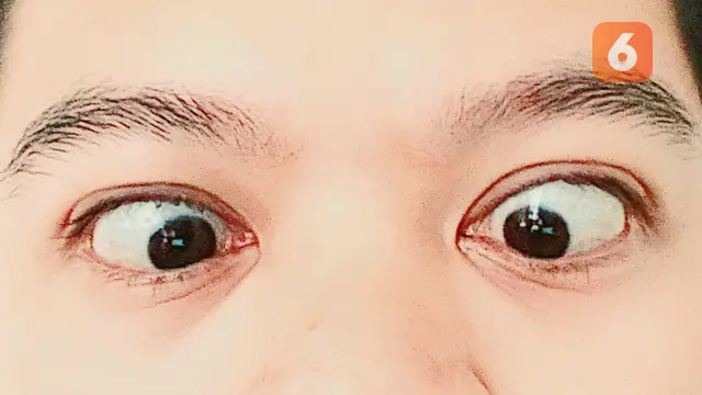 Mata Juling Bukan Sekadar Masalah Estetika, Bisa Pengaruhi Kemampuan ...