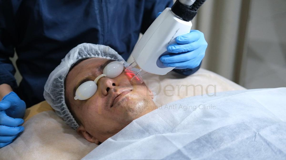 Laser CO2 Fractional Jadi Solusi Q Derma Clinic Bekas Jerawat di Kulit ...