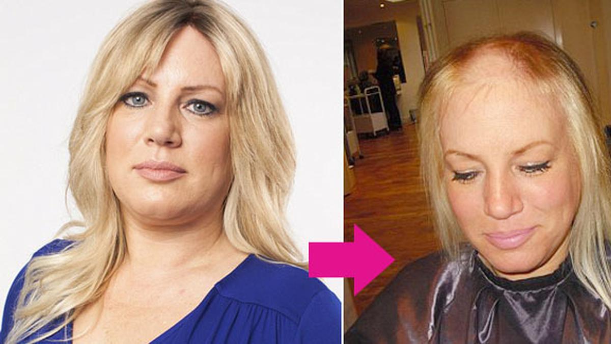 Patah Hati Bisa Membuat Rambut Wanita Rontok dan Botak - Beauty Fimela.com