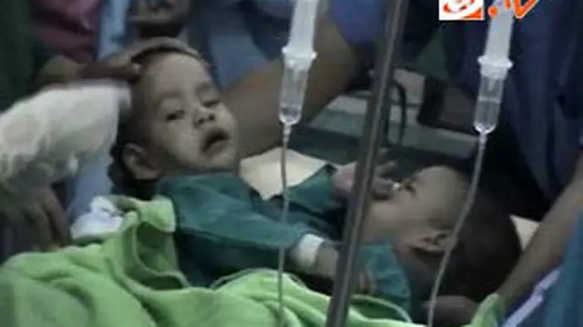 Bayi Kembar Siam Dempet Perut Dioperasi - Health Liputan6.com