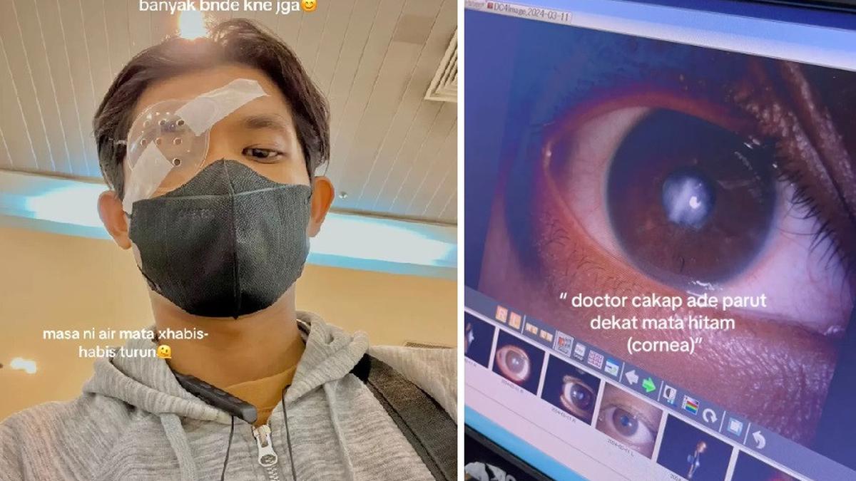 Sering Kucek Mata, Pemuda 21 Tahun Berakhir Harus Transplantasi Kornea ...