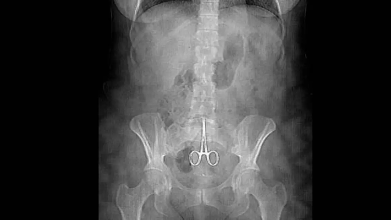 10 Foto Rontgen Dengan Benda 'Aneh' Dalam Tubuh