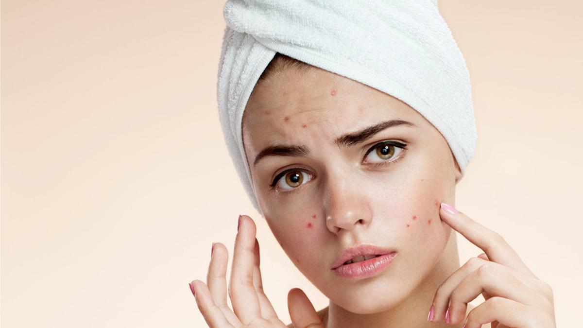 Atasi Bopeng Bekas Jerawat yang Bikin Tekstur Kulit Nggak Mulus, Begini ...
