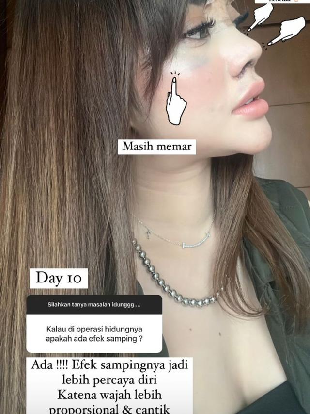 6 Potret Daniar MasterChef Usai Operasi Hidung, Jadi Sorotan