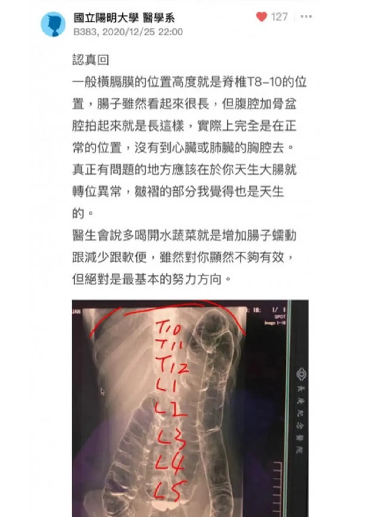 Viral Foto Rontgen Wanita Alami Sembelit Usus Sampai ke Jantung, Bikin ...