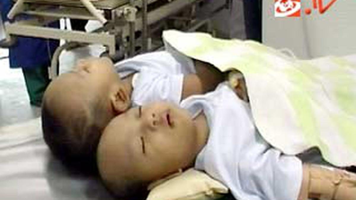 Kembar Siam Dempet Pinggul Dioperasi Pagi Ini - Health Liputan6.com