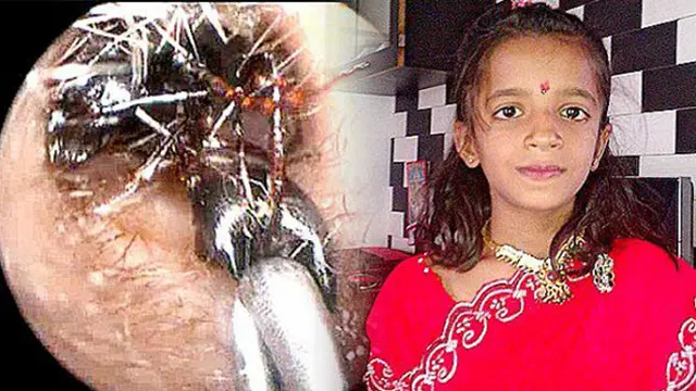 Aneh, Gerombolan Semut Selalu Keluar dari Kuping Bocah Ini - Citizen6 ...