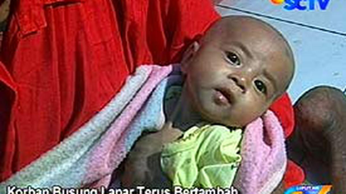 Sudah Belasan Penderita Busung Lapar Meninggal - News Liputan6.com