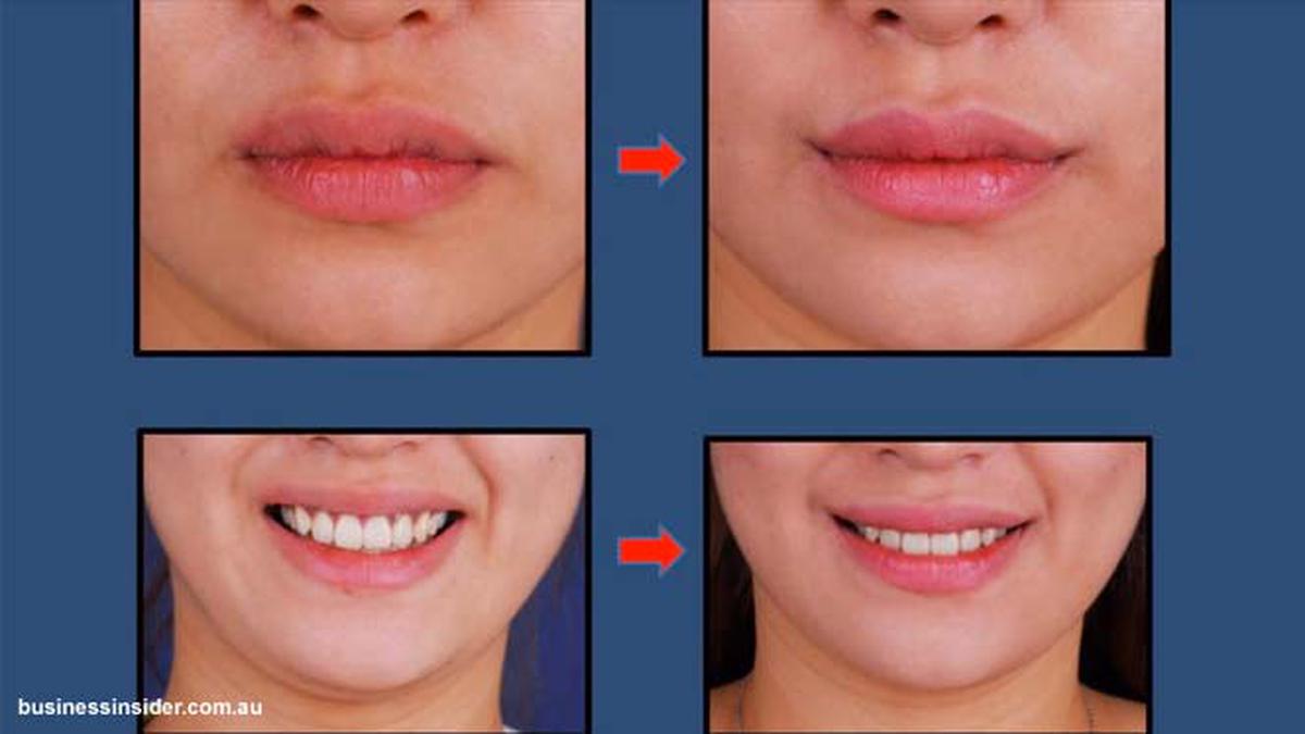 Ada Operasi Plastik yang Bikin Wajah Terus Tersenyum