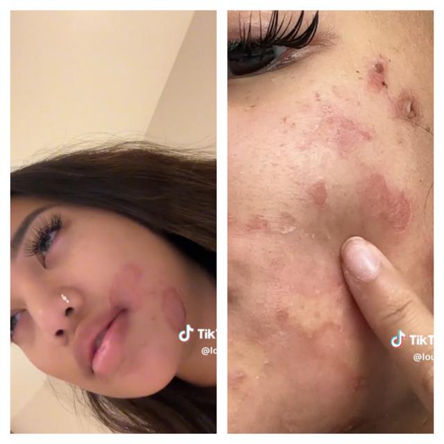 Viral di TikTok, Wajah Influencer Tertular Kurap Akibat Tak Bersihkan ...