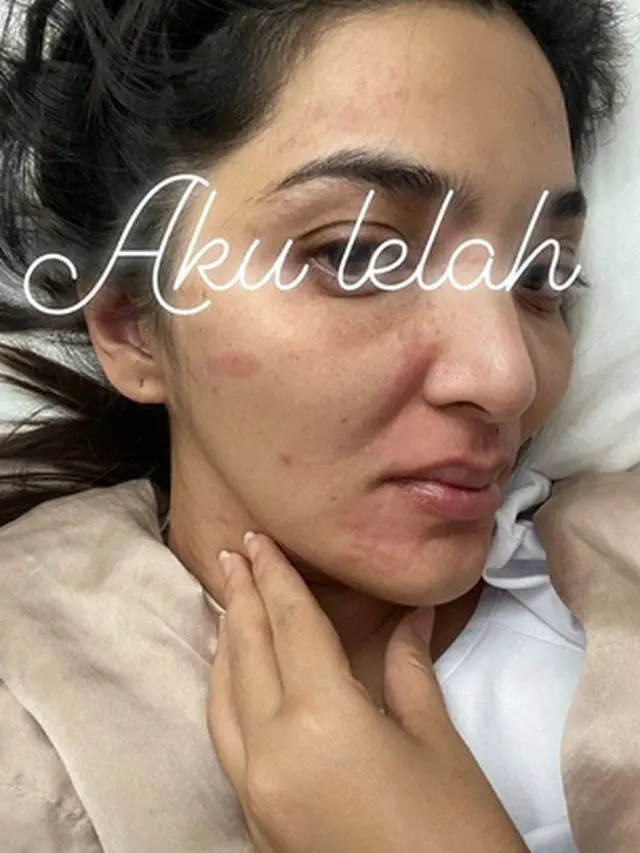6 Fakta Pengobatan Penyakit Autoimun yang Diderita Ashanty - ShowBiz ...