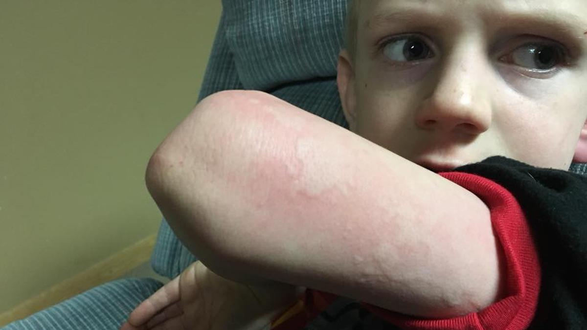 7 Gejala Biduran atau Kaligata Beserta Tips untuk Mencegahnya - Ragam ...