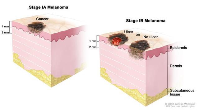 Melanoma, Kanker Kulit Akibat Sinar Matahari - Health Liputan6.com
