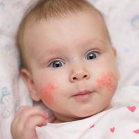 Dermatitis atopik pada bayi Terbaru - Berita, Foto, Video | Fimela.com