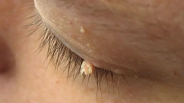 Papiloma adalah Kutil, Ini Penyebab dan Cara Mengatasinya - Hot ...