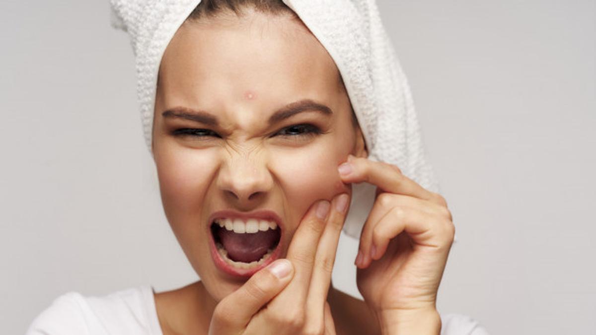 Jangan Dipencet, Ini 8 Tips Hilangkan Komedo di Wajah - On Off Liputan6.com