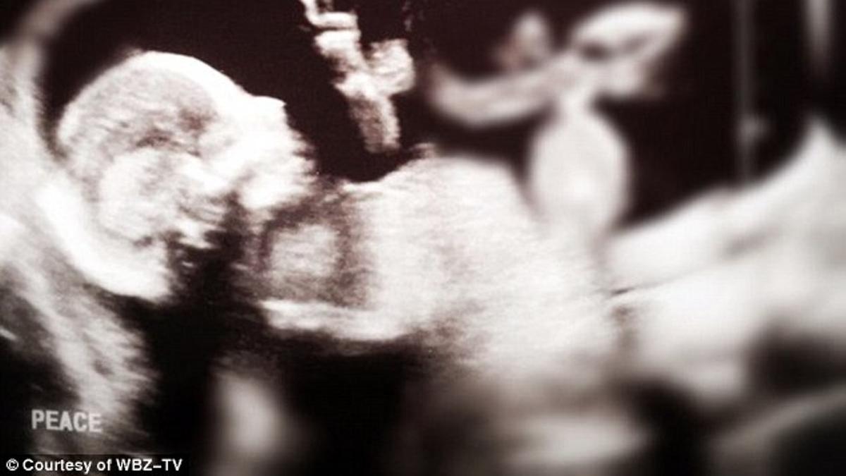 Aneh tapi Nyata, Bayi Acungkan 2 Jari 'Peace' dalam Foto USG - Global ...