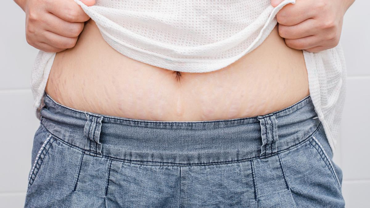 7 Cara Alami Menghilangkan Stretch Marks untuk Kulit Lebih Halus