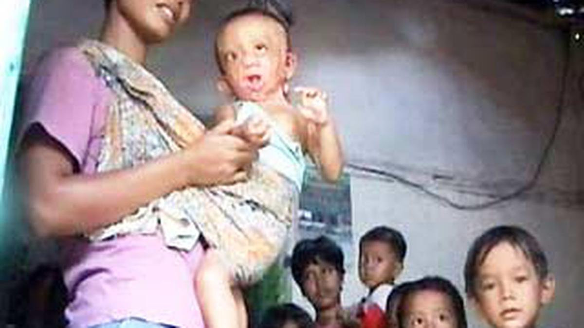 Orangtua Lalai, Anak Jadi Cacat - News Liputan6.com