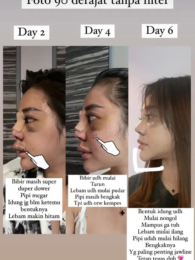 6 Potret Daniar MasterChef Usai Operasi Hidung, Jadi Sorotan - Hot Liputan6.com