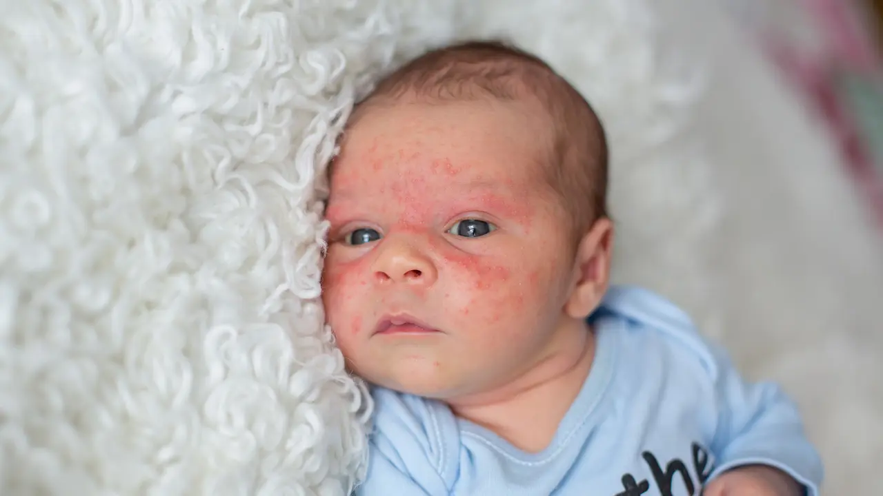 5 Gejala Dermatitis Atopik Pada Bayi, Jangan Dianggap Sepele - Hot ...