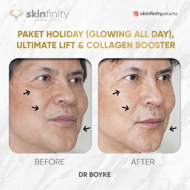 Dokter Boyke Rajin Perawatan Ultimate Lift Combo, Jadi Rahasia Wajah ...