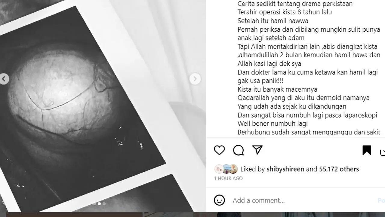 Shireen Sungkar Operasi Pengangkatan Kista untuk Kedua Kali, Besarnya Mencapai 7 Sentimeter ...