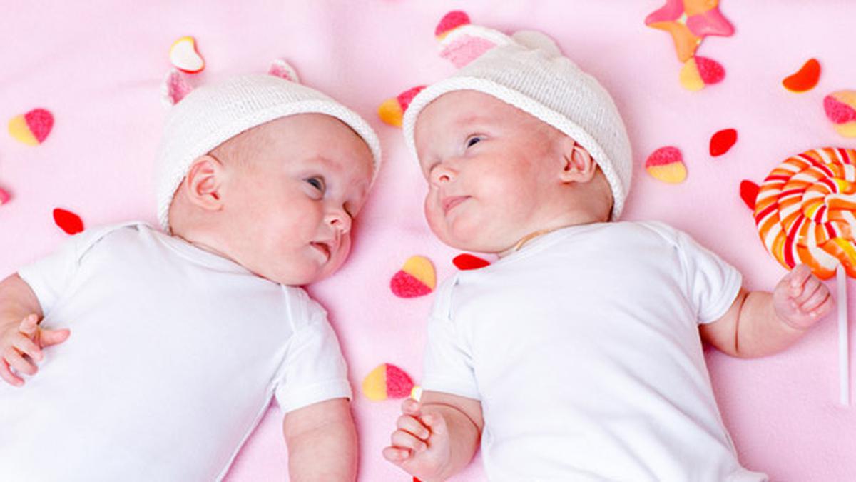 Kisah Bayi Kembar Siam Parasit, Kembarannya Menempel di Bibir