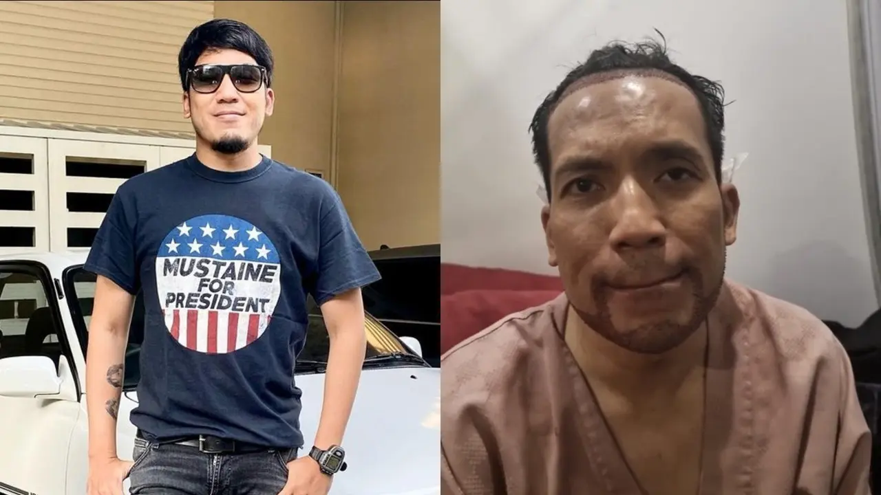 8 Potret Desta Transplantasi Rambut dan Brewok, Jidat Melebar Sejak SMA ...