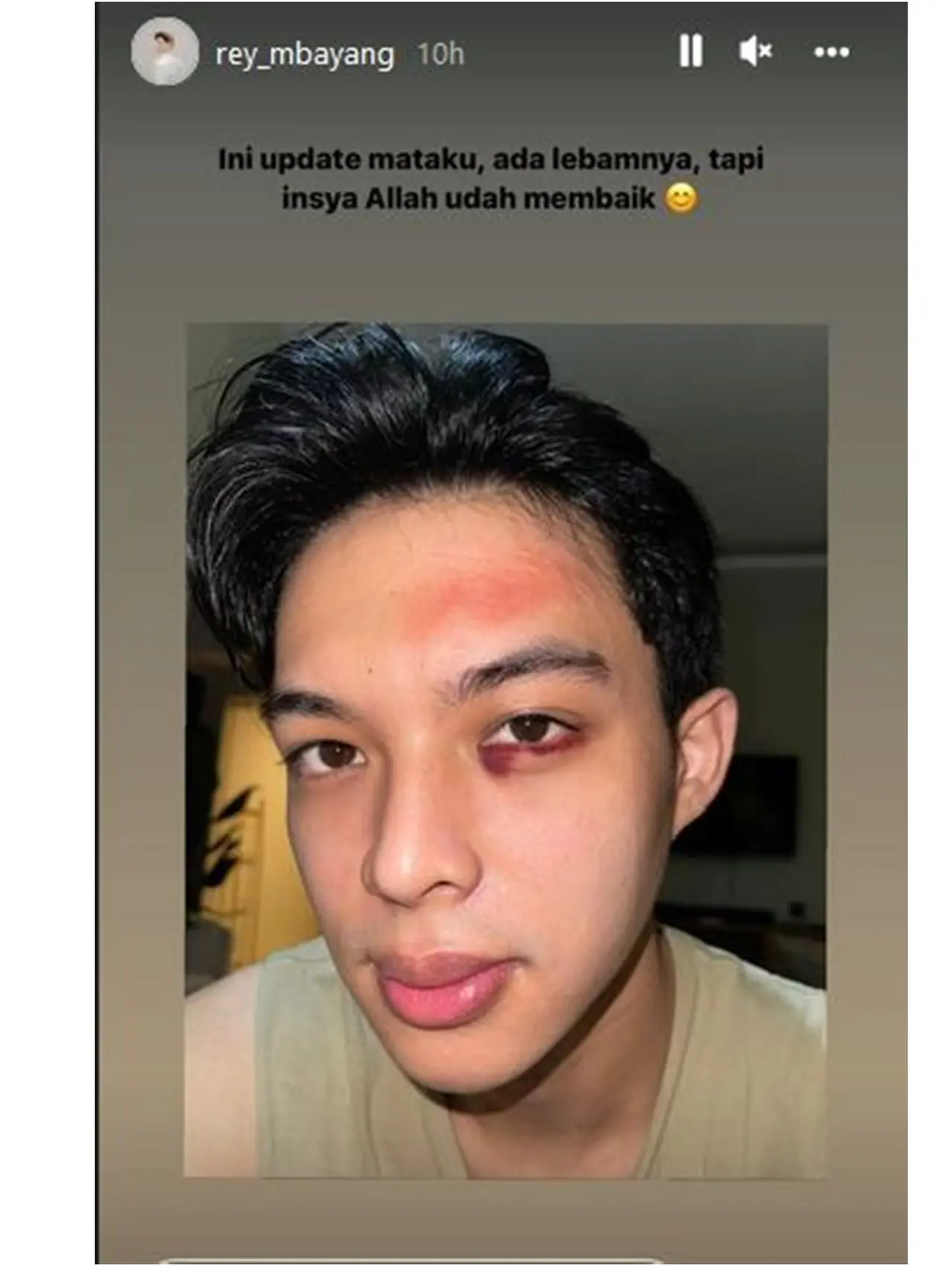 6 Potret Rey Mbayang Jalani Operasi Bagian Mata, Kini Kondisinya Masih ...