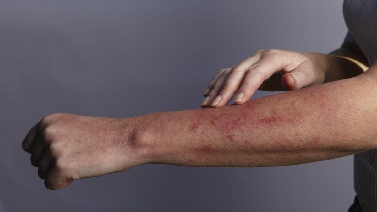 Ini Gejala Awal Penyakit Lupus yang Harus Diwaspadai