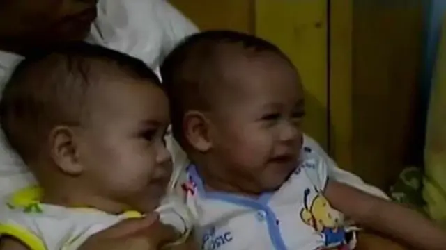 VIDEO: RSCM Berhasil Pisahkan Bayi Kembar Siam Safira dan Saqira - News Liputan6.com