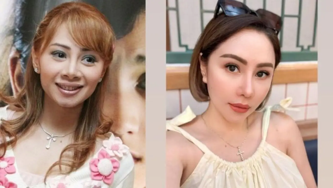 9 Potret Artis Sebelum dan Sesudah Filler Dagu, Wajah Makin Tirus dan ...